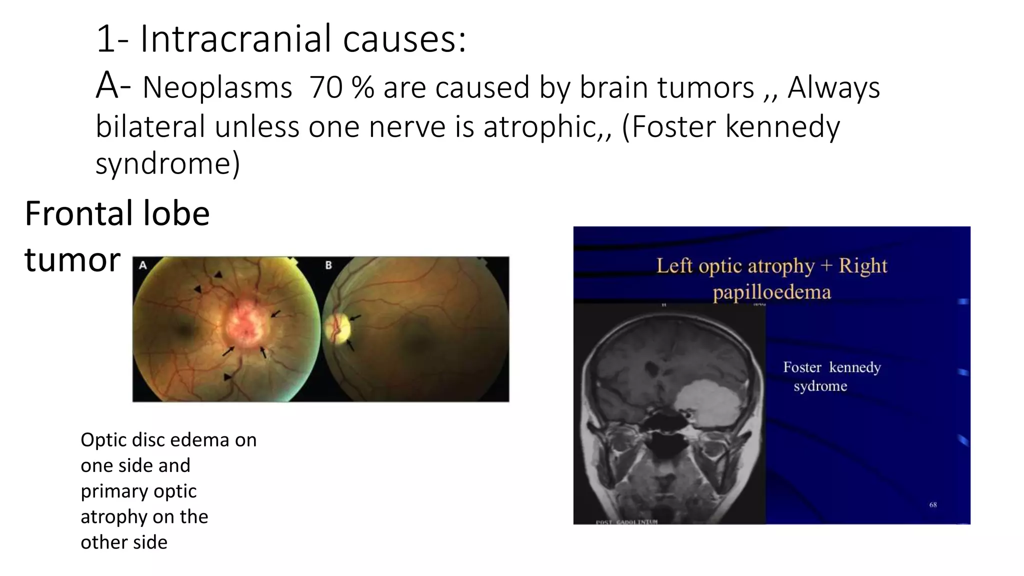Optic Nerve and pupil tutorial | PPTX