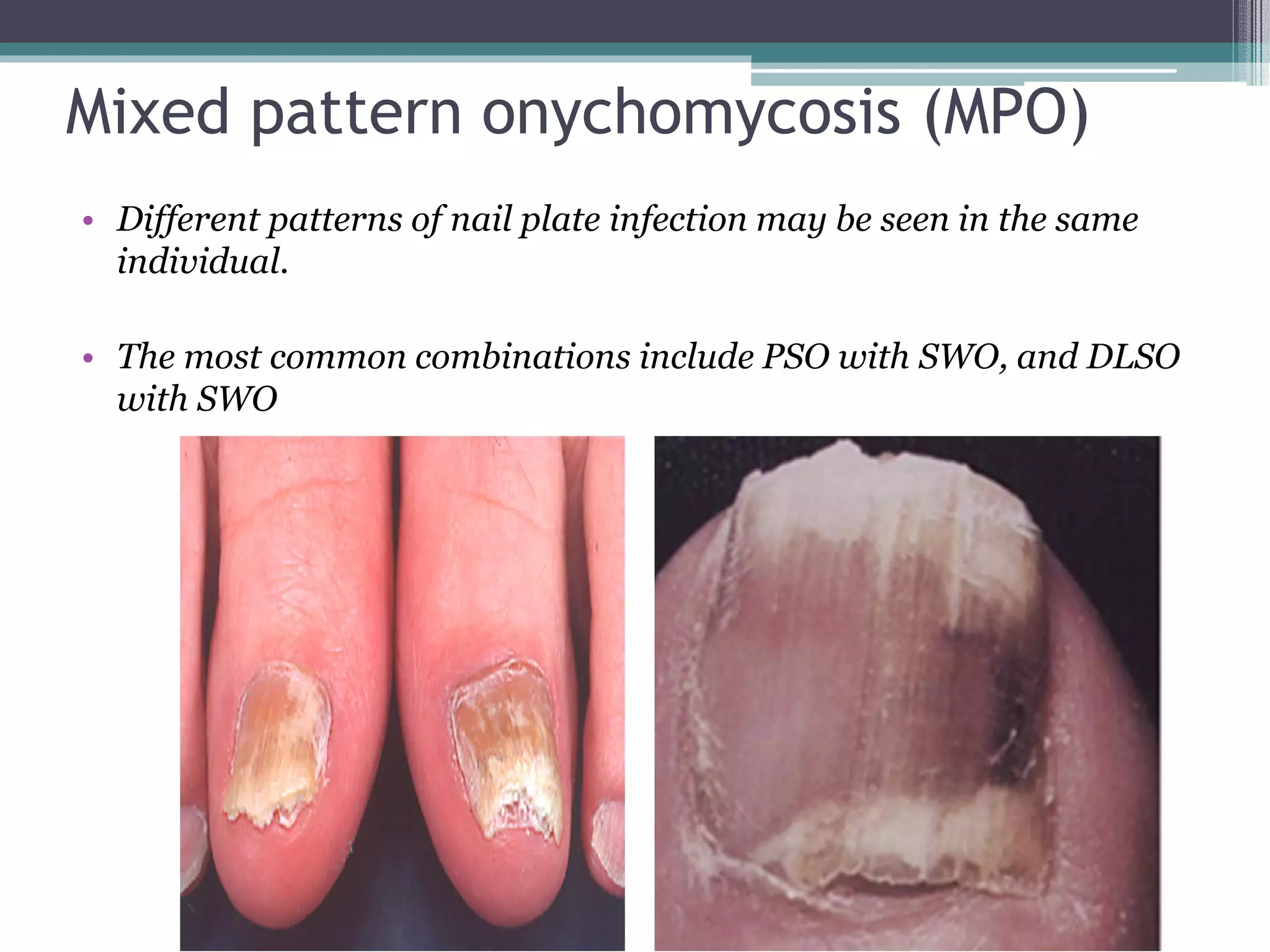 Onychomycosis tim - | PDF