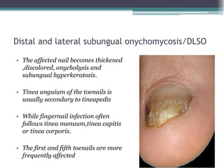 Distal And Lateral Subungual Onychomycosis