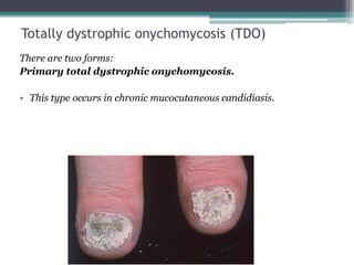 Total Dystrophic Onychomycosis