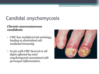 Candidal Onychomycosis