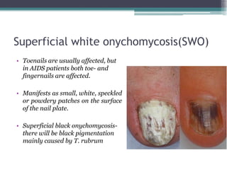 onychomycosis-tim-copy-190413065334 (1).pptx