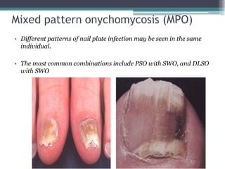 onychomycosis-tim-copy-190413065334 (1).pptx