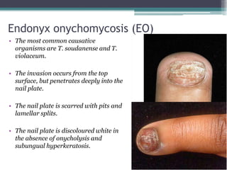 Endonyx Onychomycosis