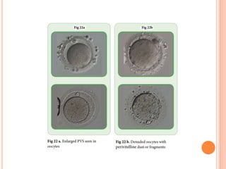 Oocyte grading.pptx... dhsvsusvshshhshsh | PPTX