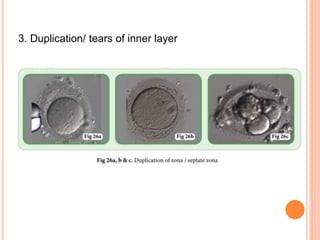 Oocyte grading.pptx... dhsvsusvshshhshsh | PPTX