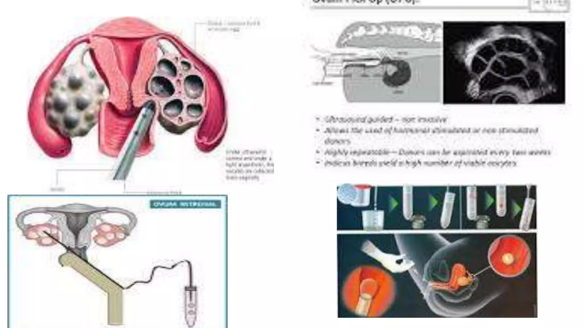 Oocyte pick up and Embryo transfer | PPTX
