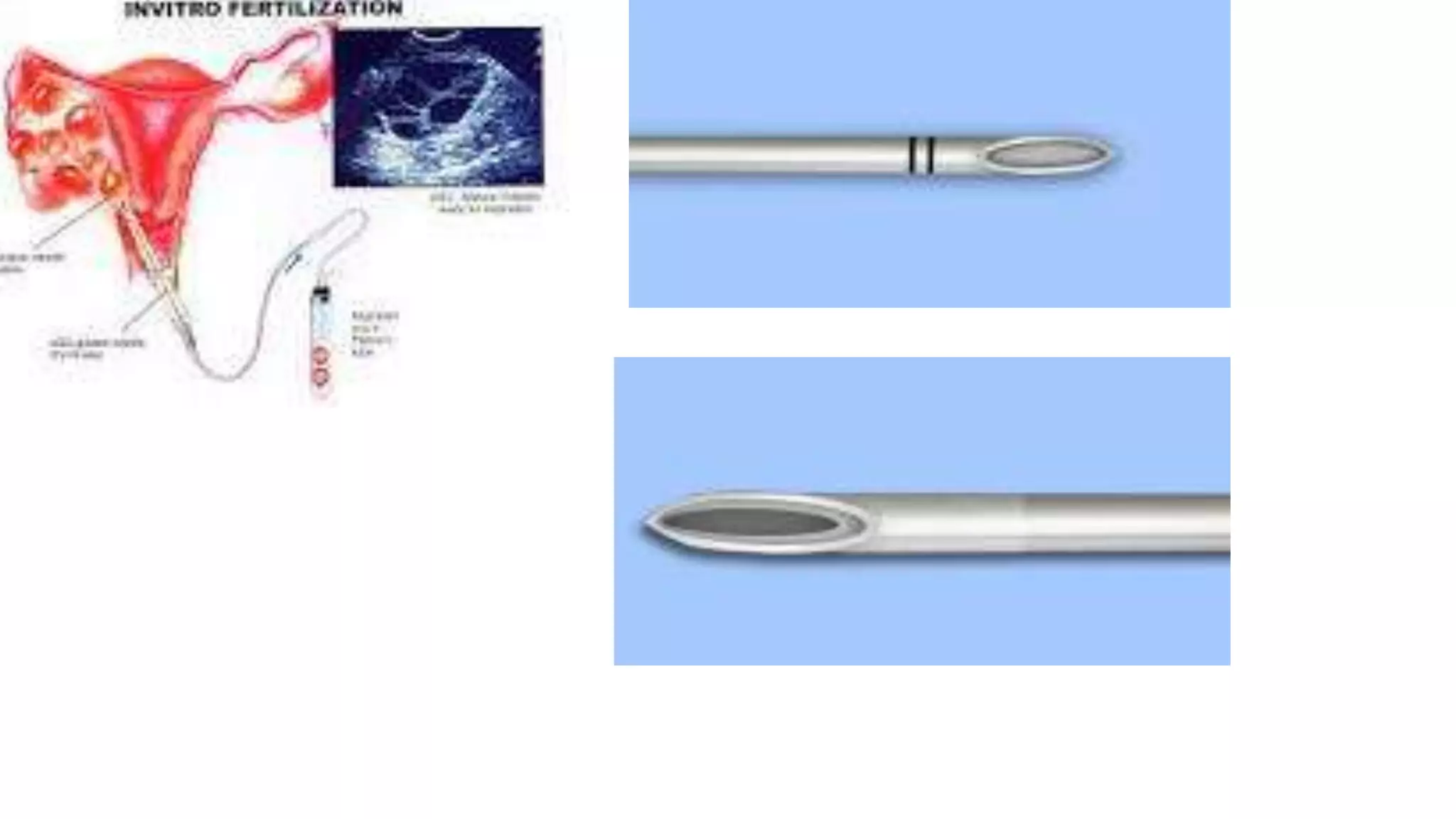 Oocyte pick up and Embryo transfer | PPTX