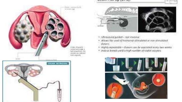 Oocyte pick up and Embryo transfer | PPTX | Pregnancy | Reproductive Health