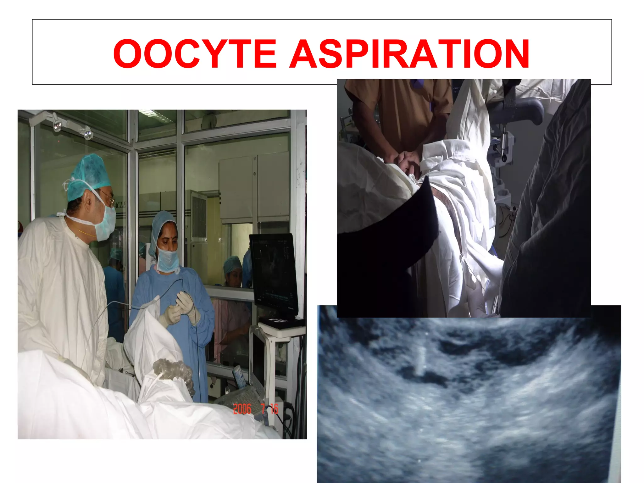 Oocyte retrival | PPT