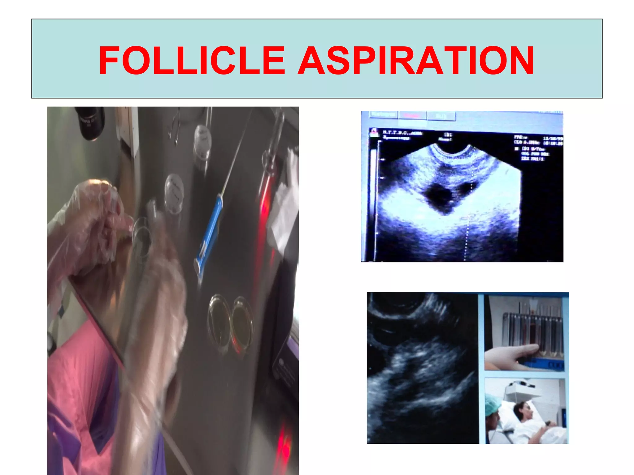 Oocyte retrival | PPT