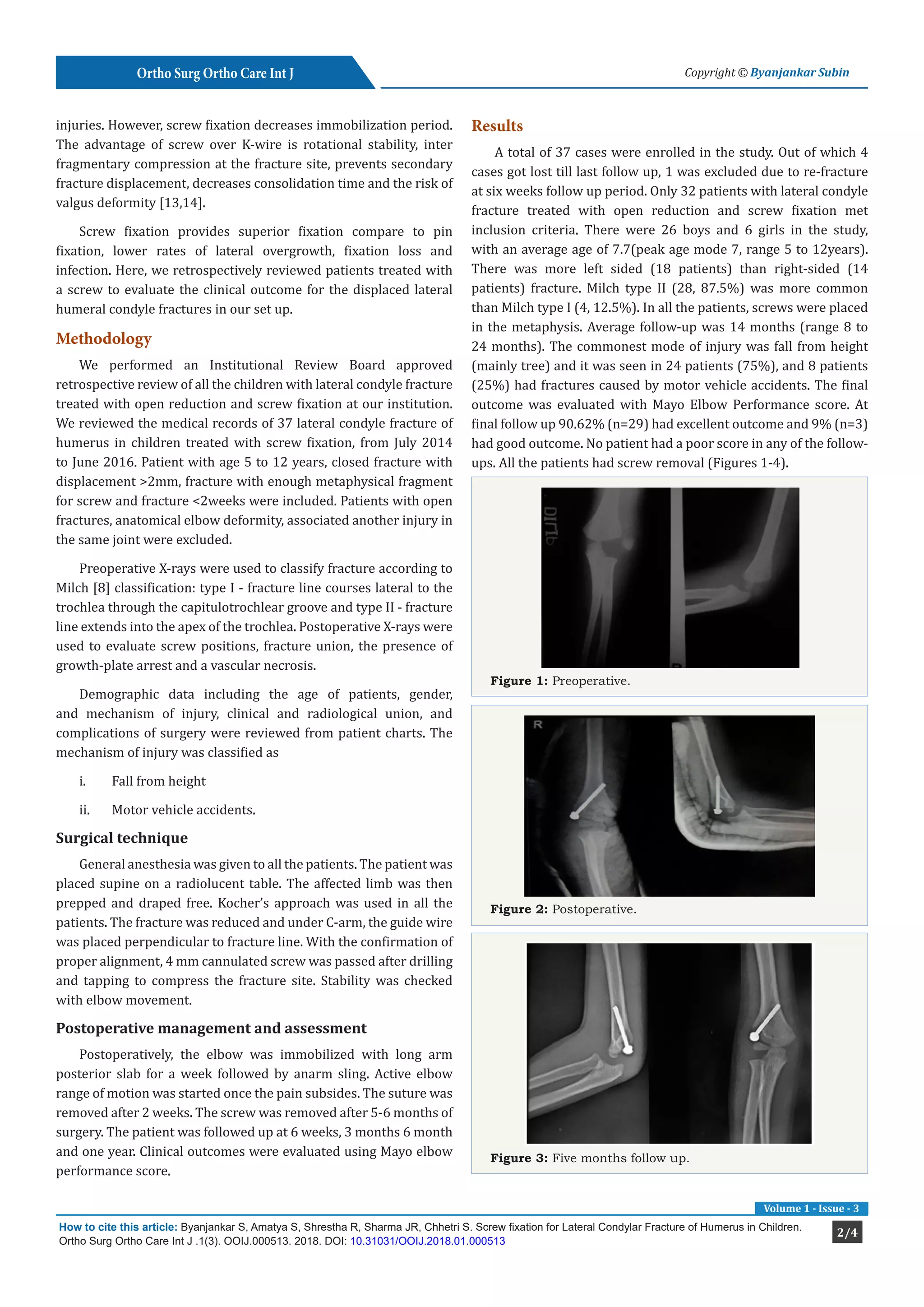 Screw fixation for Lateral Condylar Fracture of Humerus in Children | PDF