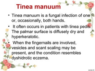 fungal infection of skin ppt | PPT