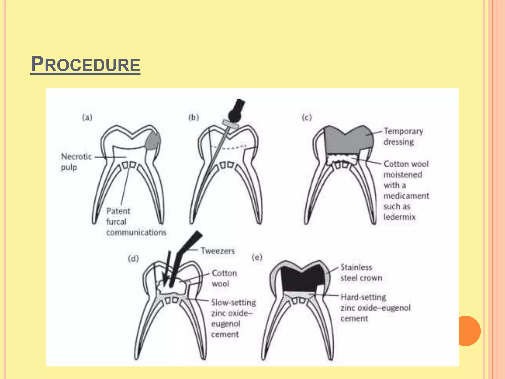 Difference between pulpotomy and pulpectomy | PPTX