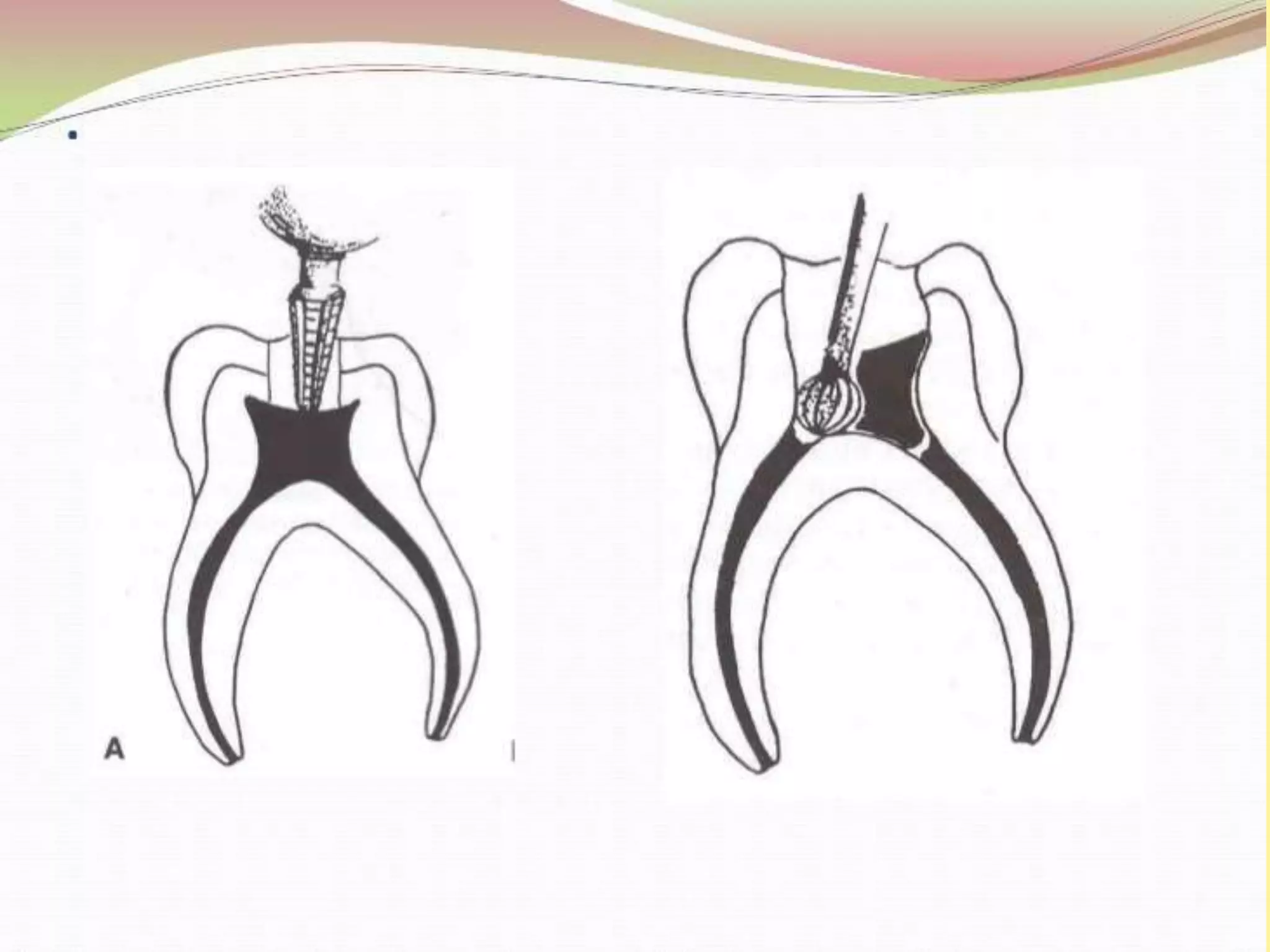 Difference between pulpotomy and pulpectomy | PPTX