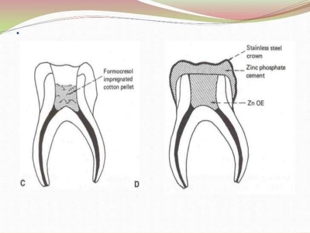 Difference between pulpotomy and pulpectomy