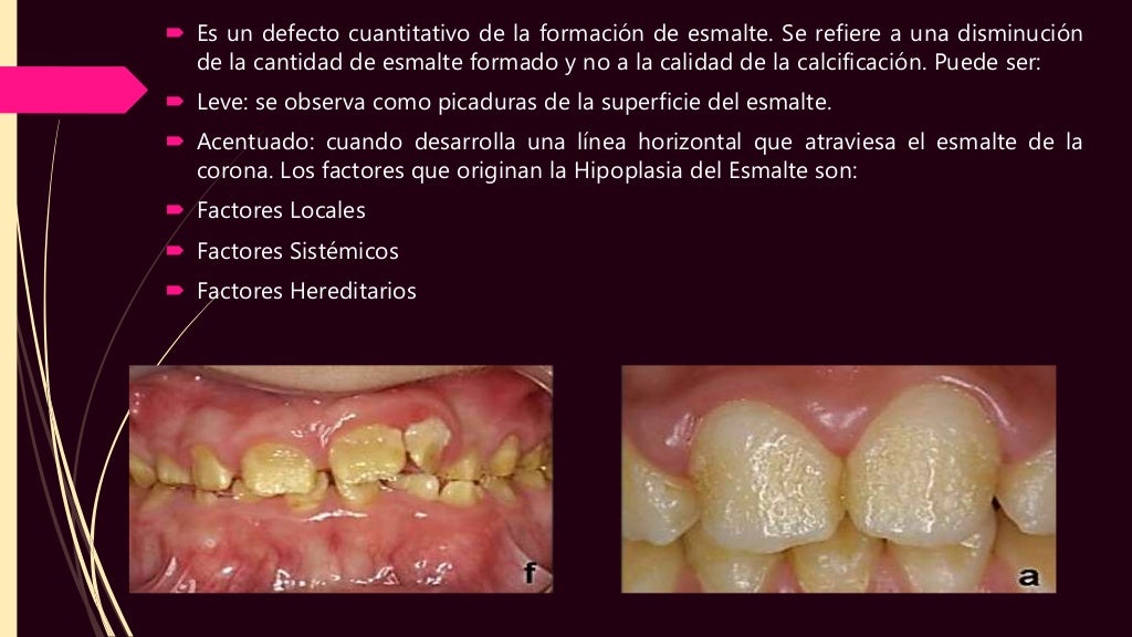 esmalte dental