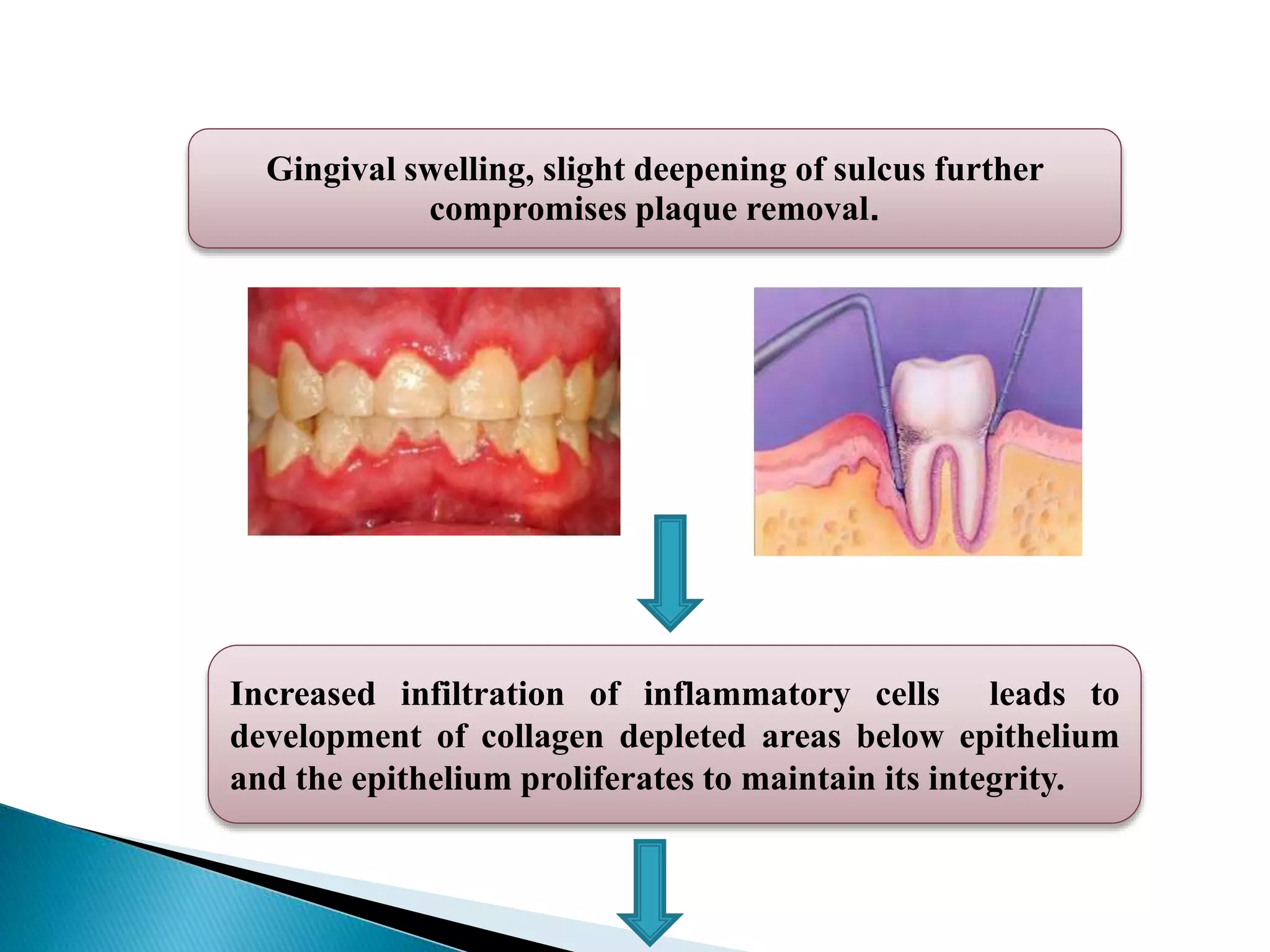 Periodontal pathogenesis | PPTX