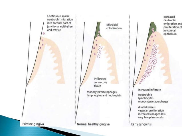 Periodontal pathogenesis | PPTX