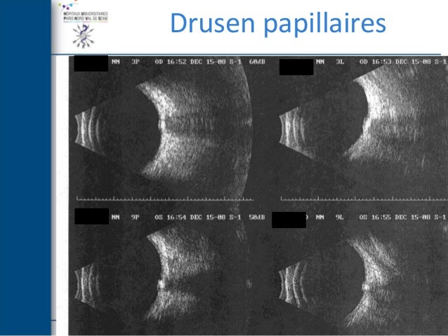[DES1 Urgences] Oedeme papillaire / Dr C.Lamirel (23 mars 2013)
