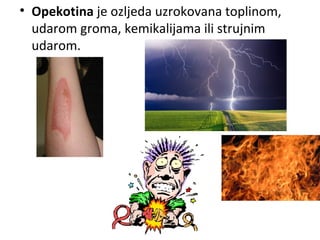 Opekotine | PPT