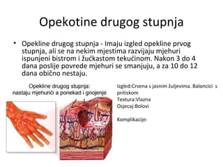 Opekotine | PPT