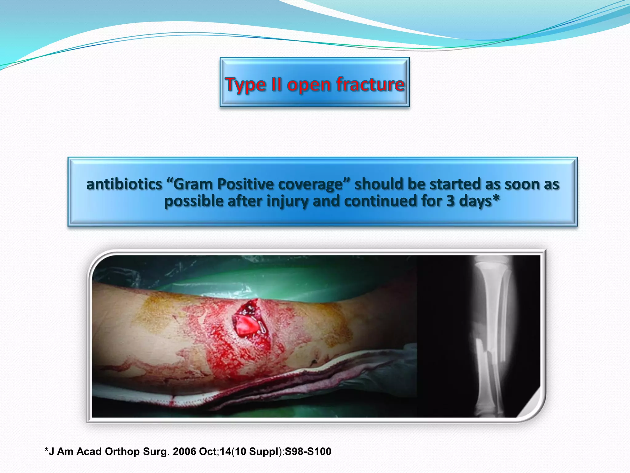 Open Fracture Antibiotics prophylaxis | PDF
