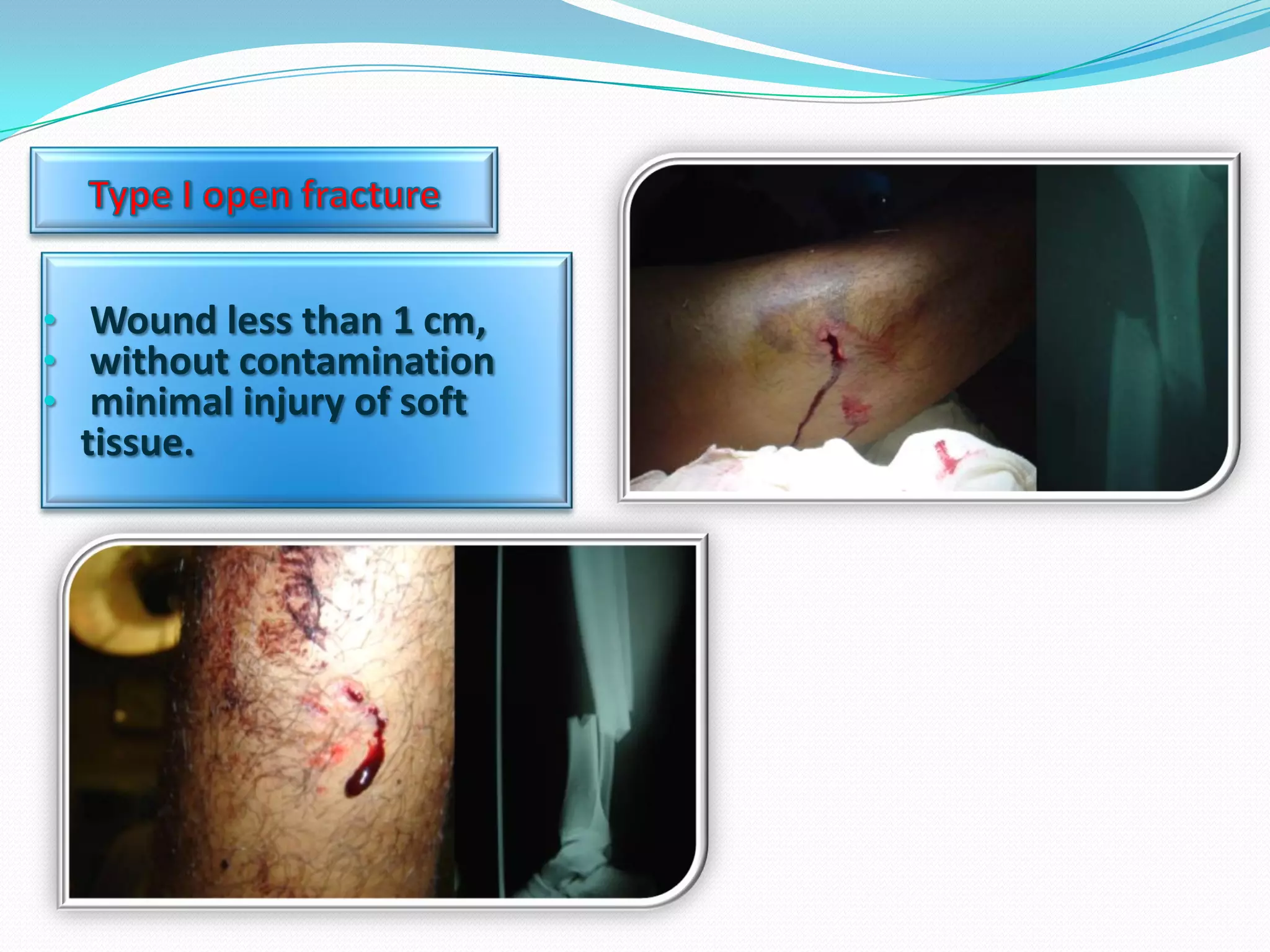 Open Fracture Antibiotics prophylaxis | PPT