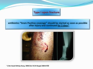 Open Fracture Antibiotics prophylaxis | PDF
