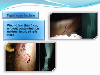 Open Fracture Antibiotics prophylaxis | PDF