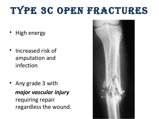 Open fractures
