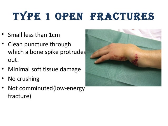 Open fractures