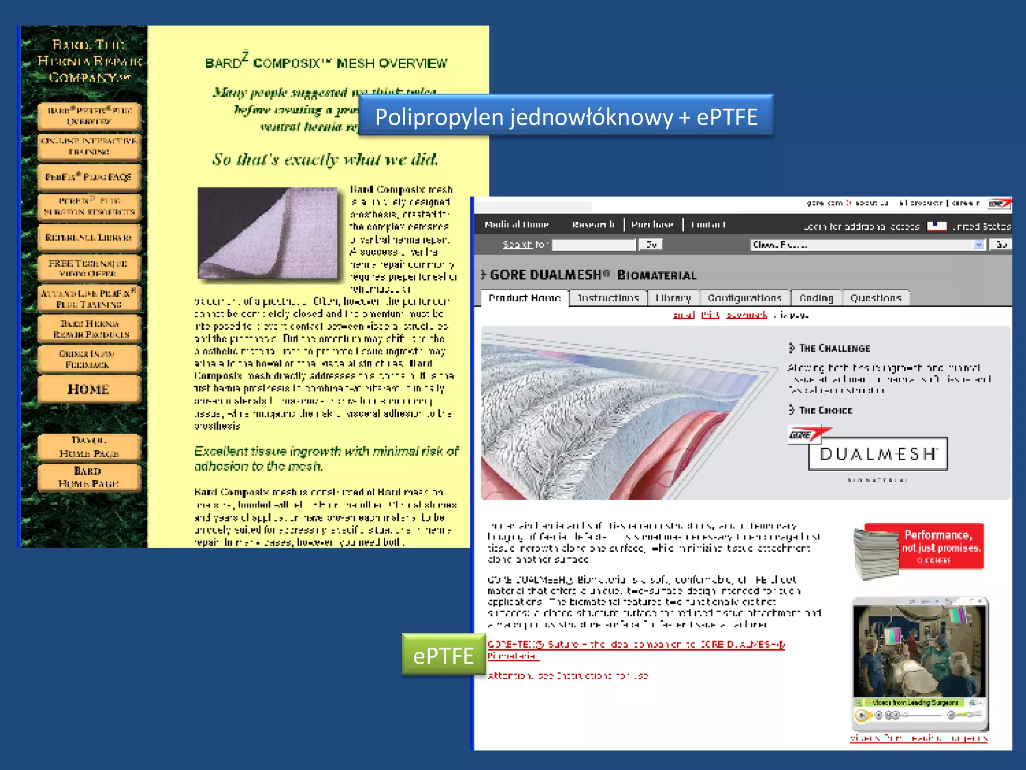 Open Ipom Ventral Hernia Repair | PPT