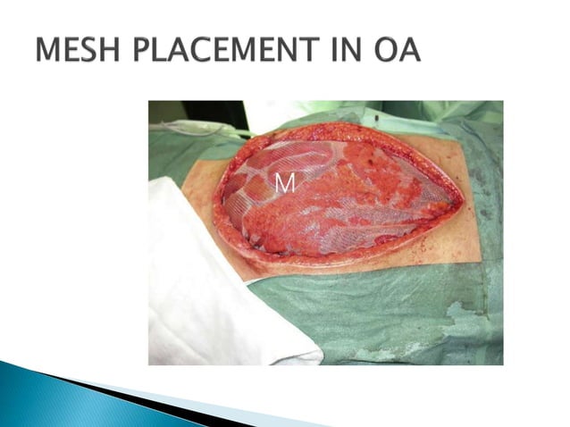 Open abdomen and its management | PPTX | Digestive Disorders | Diseases ...