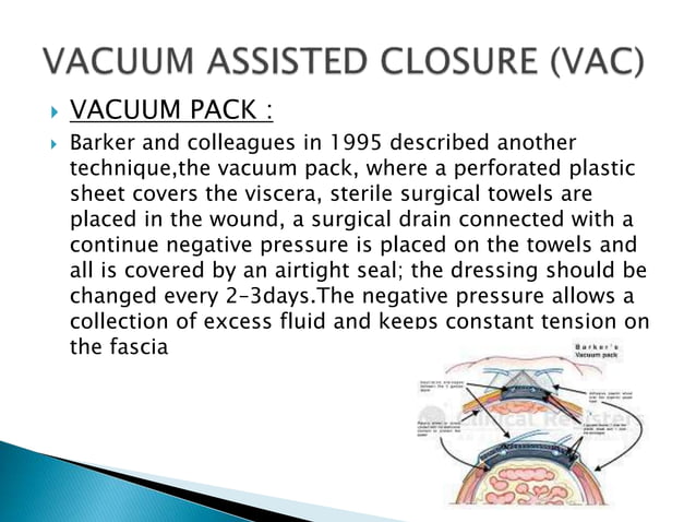 Open abdomen and its management | PPTX | Digestive Disorders | Diseases ...