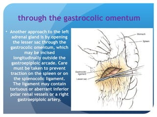Open surgical Adrenalectomy for adrenal tumors the lect.ppt