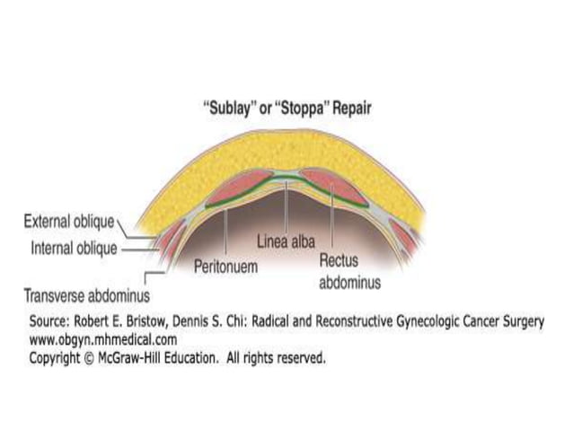 Open and laproscopic repair of incisional hernia | PPT