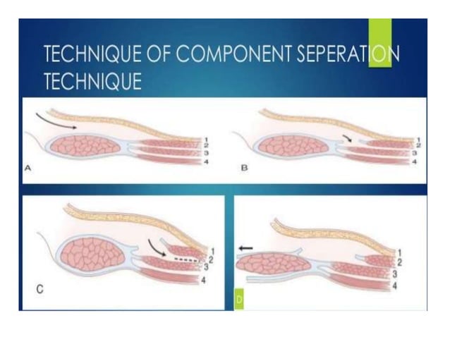 Open and laproscopic repair of incisional hernia | PPT