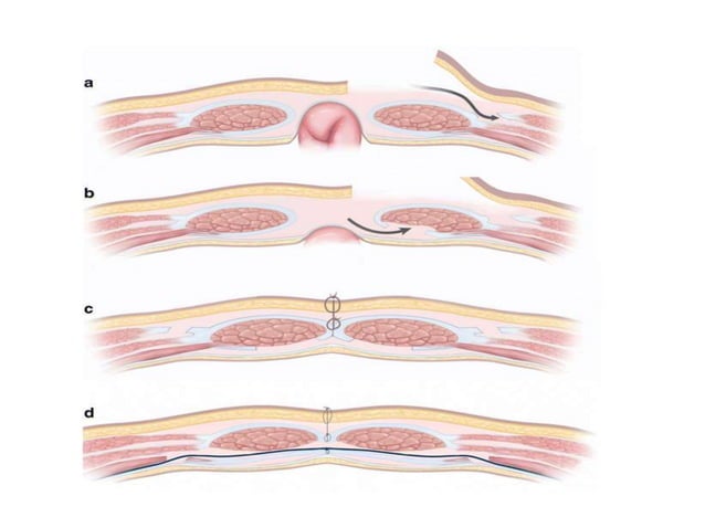 Open and laproscopic repair of incisional hernia | PPT