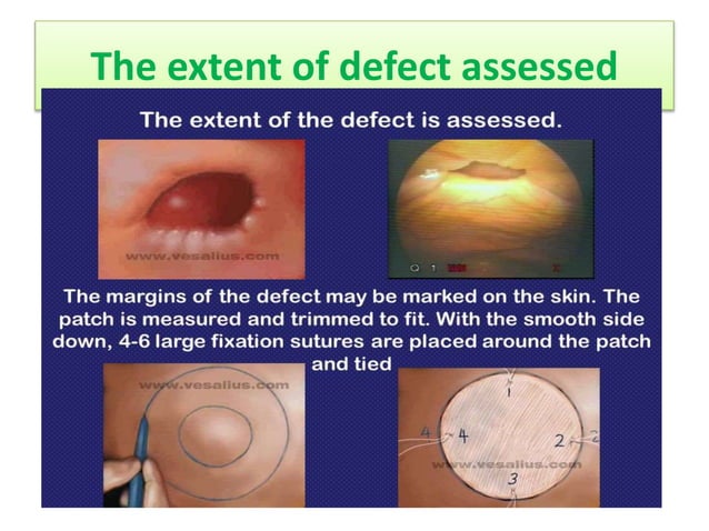 Open and laproscopic repair of incisional hernia | PPT
