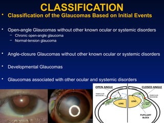 Open Angle Glaucoma diagnosis and treatment | PPTX