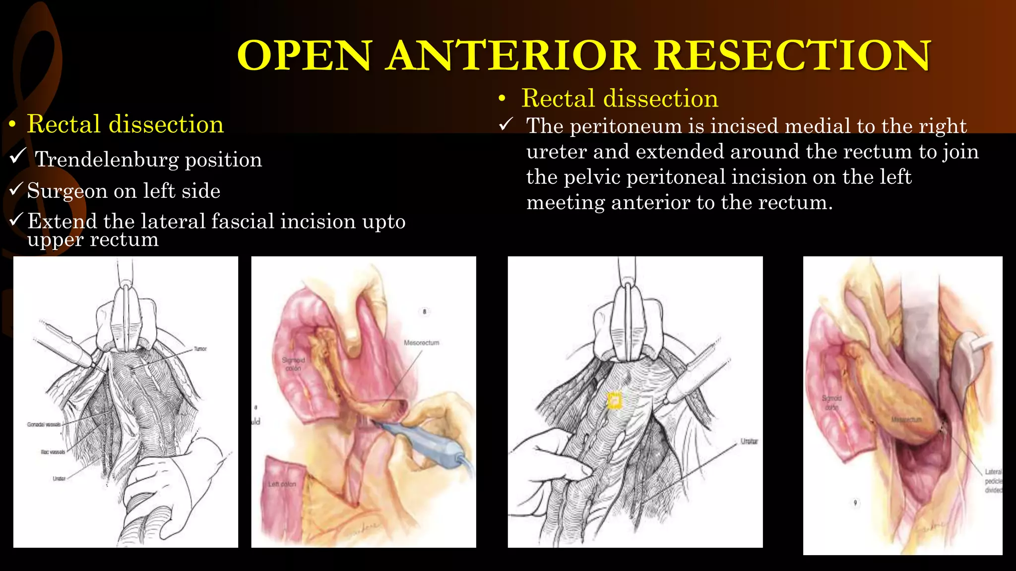 OPEN ANTERIOR RESECTION-STEP BY STEP Operative Surgery.pptx