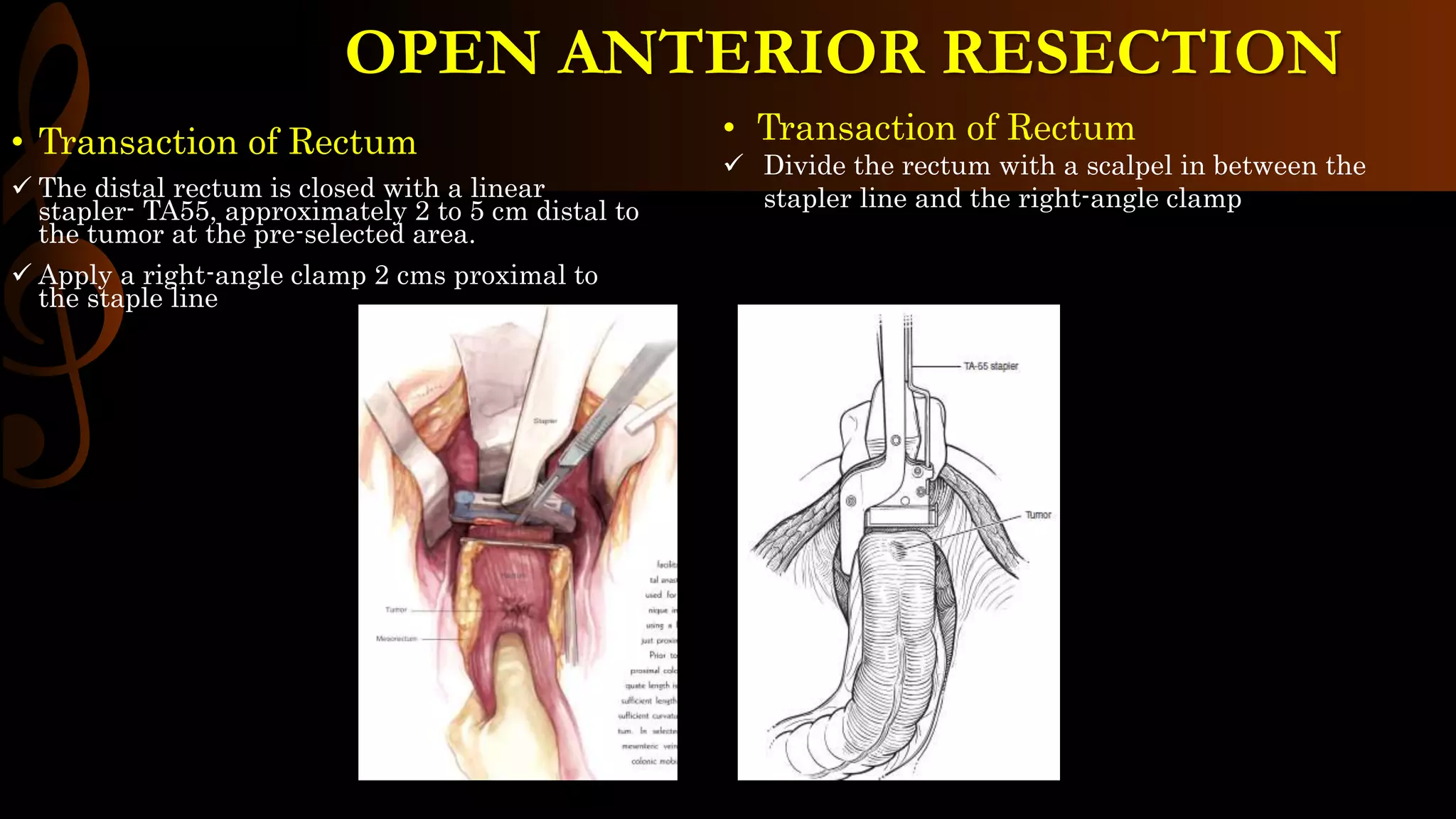 Open Anterior Resection Step By Step Operative Surgerypptx