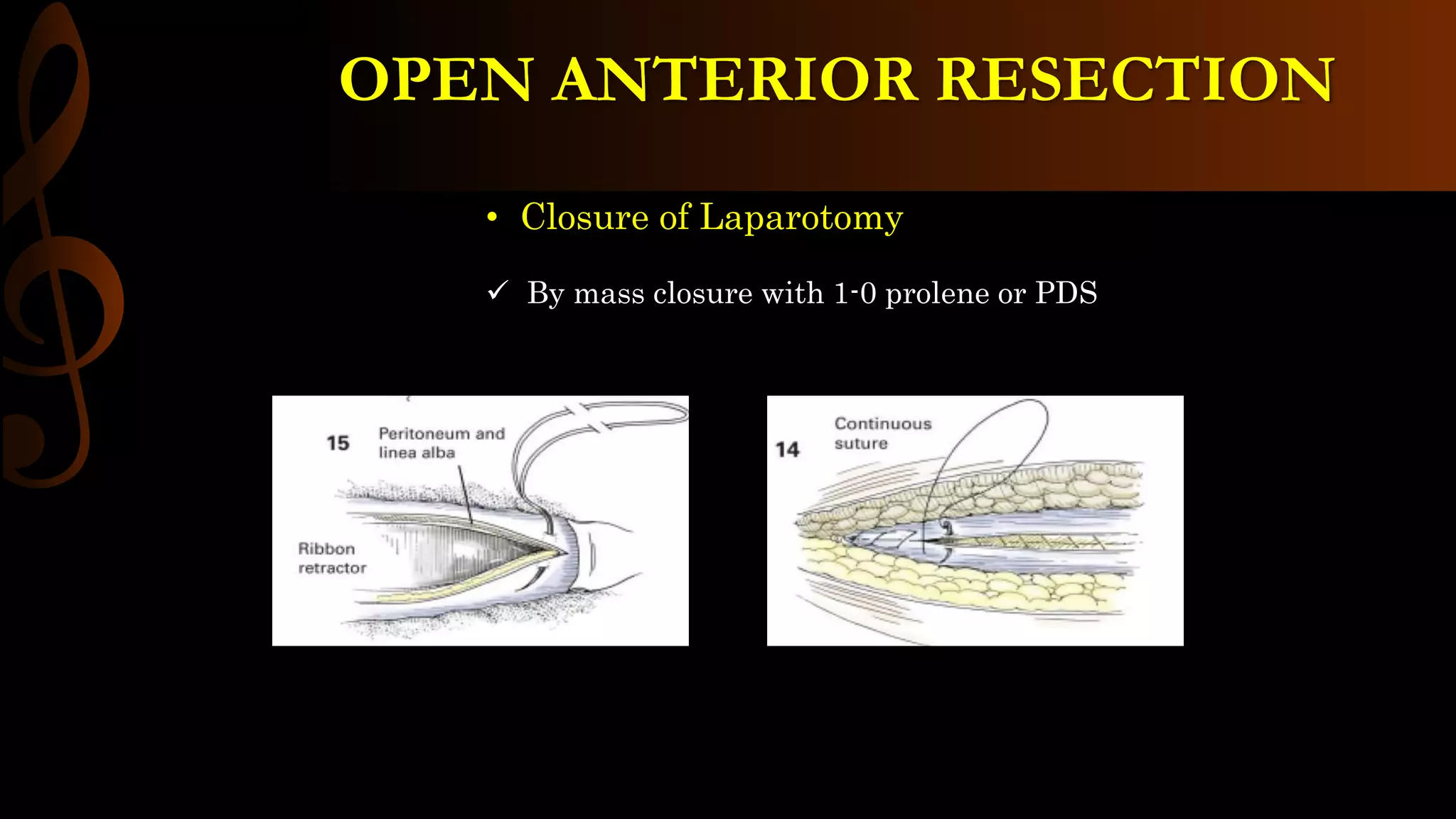 OPEN ANTERIOR RESECTION-STEP BY STEP Operative Surgery.pptx