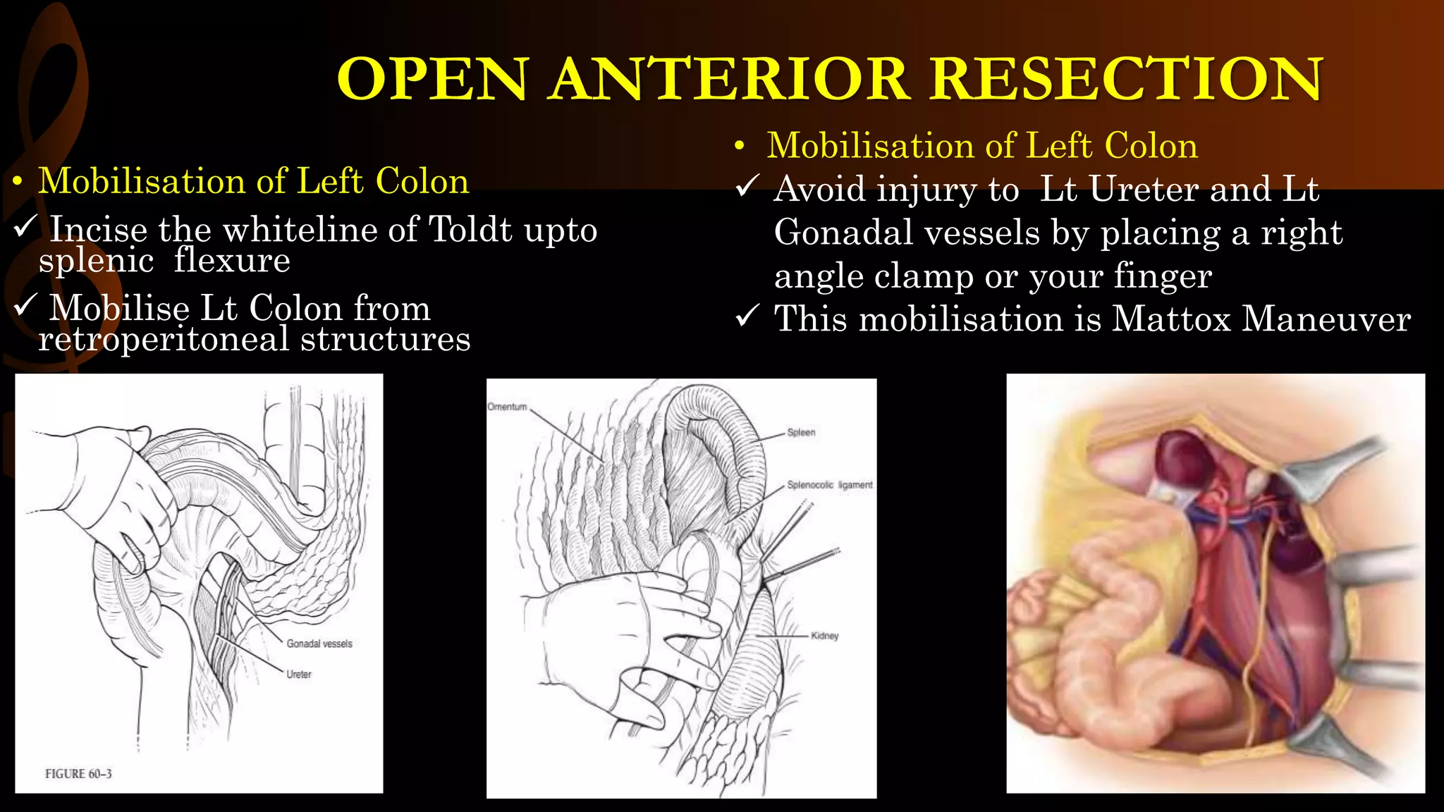 OPEN ANTERIOR RESECTION-STEP BY STEP Operative Surgery.pptx