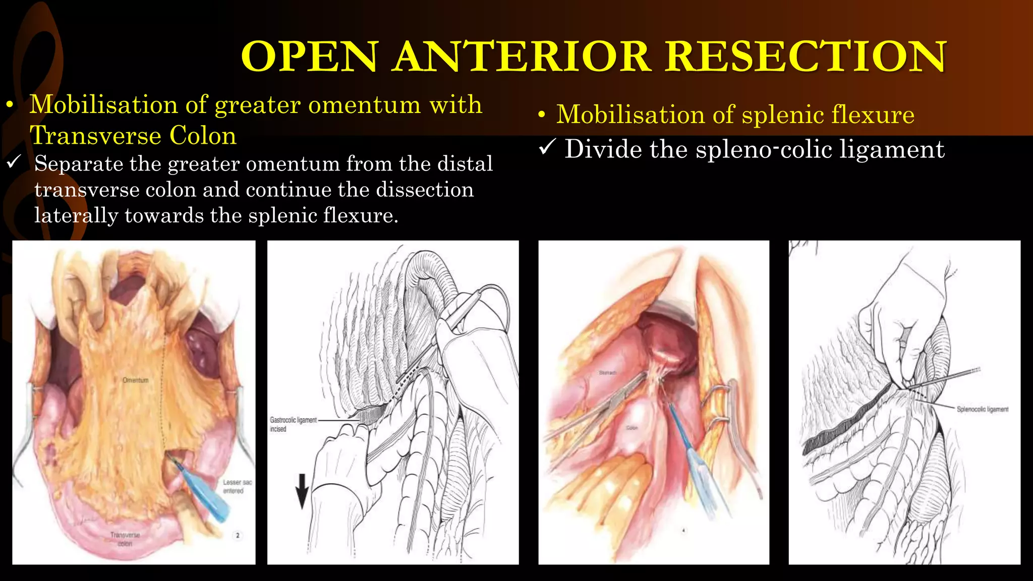 OPEN ANTERIOR RESECTION-STEP BY STEP Operative Surgery.pptx