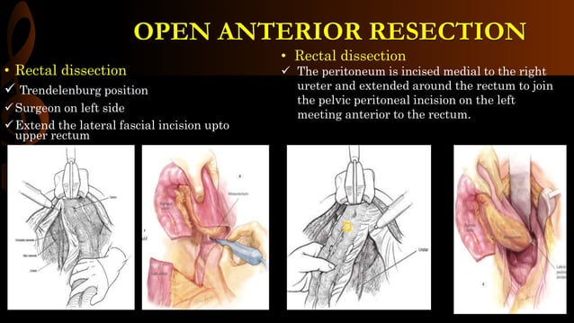 OPEN ANTERIOR RESECTION-STEP BY STEP Operative Surgery.pptx