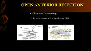 OPEN ANTERIOR RESECTION-STEP BY STEP Operative Surgery.pptx