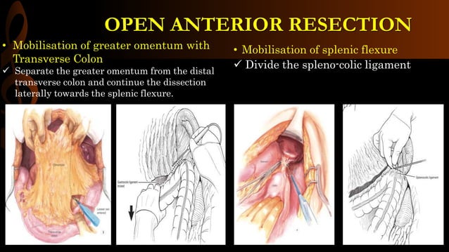 OPEN ANTERIOR RESECTION-STEP BY STEP Operative Surgery.pptx