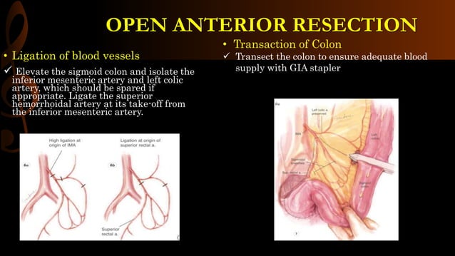 OPEN ANTERIOR RESECTION-STEP BY STEP Operative Surgery.pptx